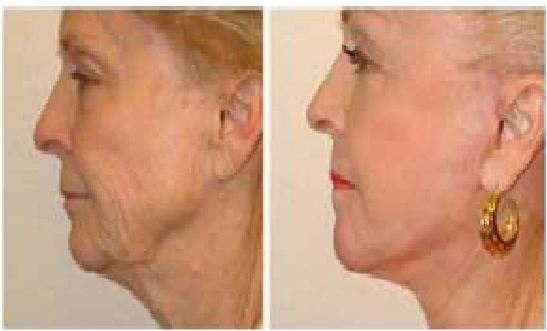 Comparing different facelift methods with picture - RoseMedTour